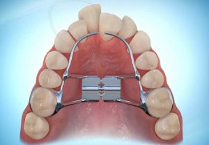 What is a Rapid Palate Expander? - Healthrow.net