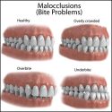 Malocclusion: Definition, Classes, and Types - Healthrow.net