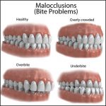 Malocclusion: Definition, Classes, and Types - Healthrow.net