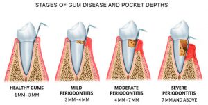 Sensitive Gums: Causes, Symptoms and Remedies - Healthrow.net