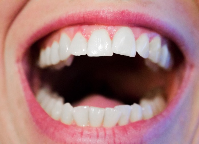 How Long do White Fillings Last? - Healthrow.net