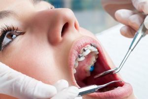 Ligature Ties for Braces: Use, Appearance & Maintenance - Healthrow.net