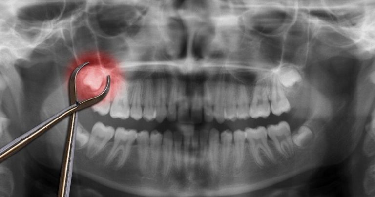Wisdom Tooth Infection: Causes, Symptoms & Treatment - Healthrow.net