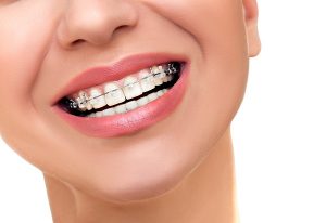 4 Tips to Remove Ceramic Braces Stains - Healthrow.net