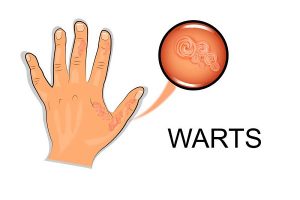 Periungual Warts: Causes, Treatment & Prevention - Healthrow.net