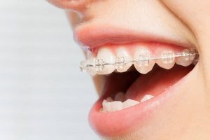 Braces Archwire Sequence: Everything You Need to Know - Healthrow.net
